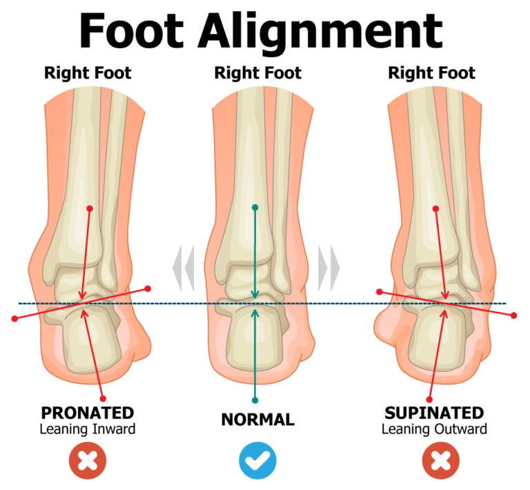 Guide To Foot Pronation, What It Is and What To Do About It