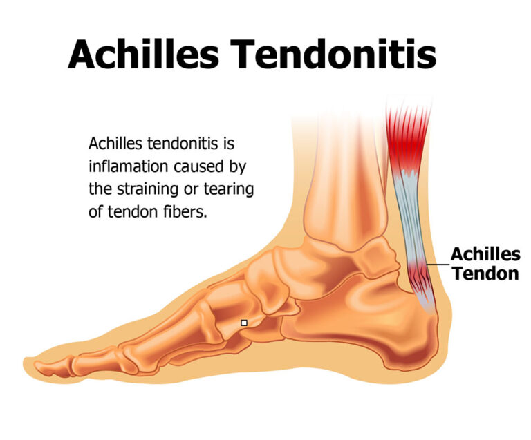 How Orthotics Can Help Relieve Achilles Tendonitis Pain