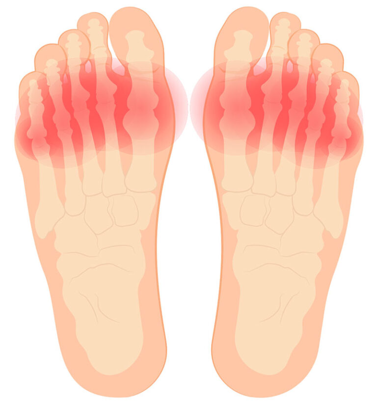 Orthotics for Metatarsalgia and Ball of Foot Pain