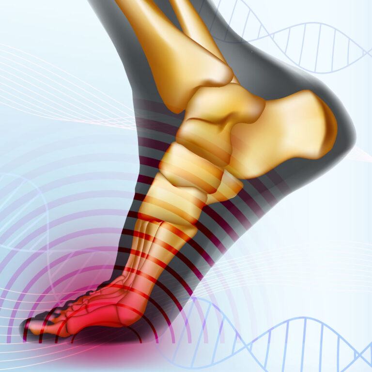 Custom Orthotics For Hallux Rigidus Pain | Twin Cities MN